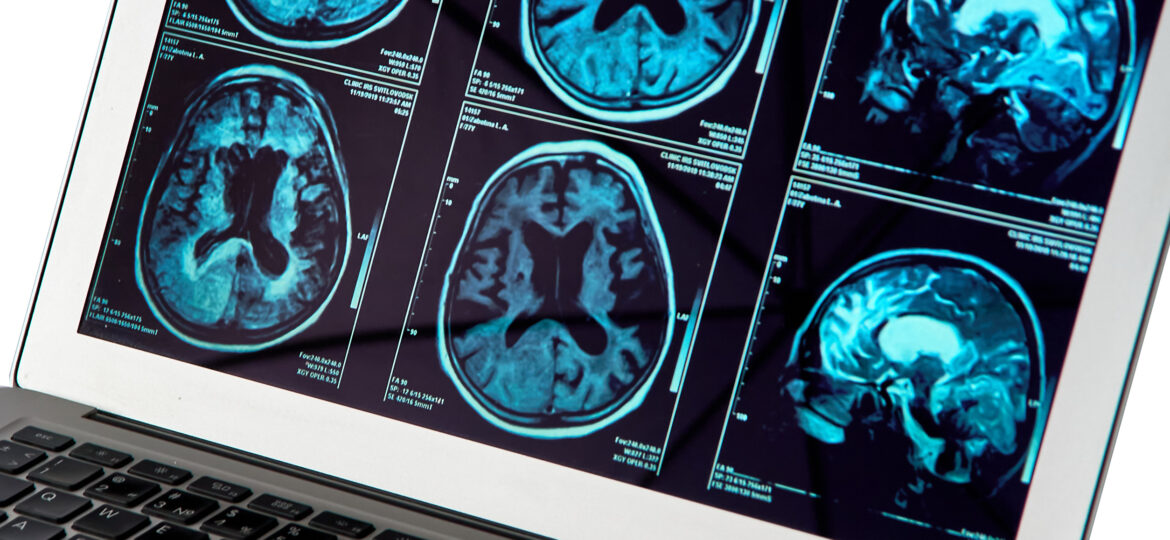 Misconceptions About Brain Injuries- Winstein, Kavensky & Cunningham